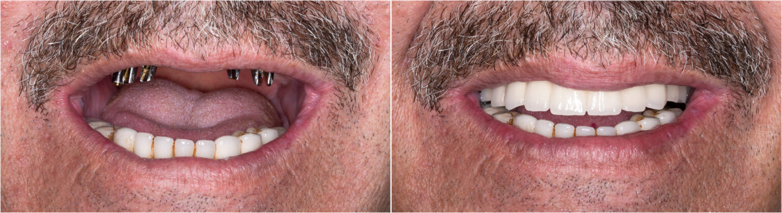 Overdentures and Implant Overdentures in Kingston, London.