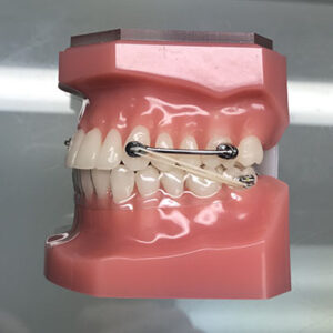 Motion Appliance | Specialist Orthodontist | Kingston, London