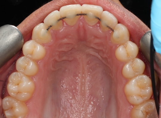 Dental Retainers | Free Consultation | Weekend Appointments