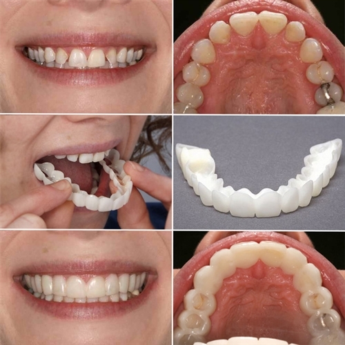 Snap-On Smile - Pearl Dental Clinic