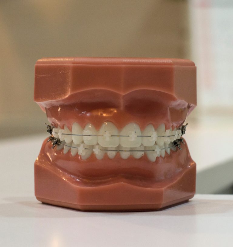 Types Of Braces For Teeth at Pearl Dental Clinic, Kingston, London.